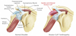 Rotator Cuff Tendinopathy Info | Connect Healthcare Norwood